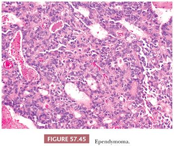 Fallopian Tube and Broad Ligament | Basicmedical Key