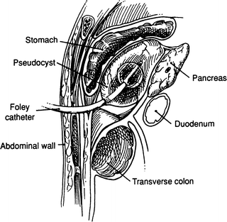 Pancreas | Basicmedical Key