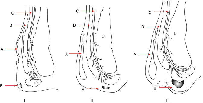 Haemorrhoids: Anatomy, Pathophysiology and Presentation | Basicmedical Key