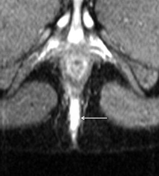 Imaging of Anal Sepsis | Basicmedical Key