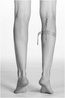 Examination of the lower limb venous system | Basicmedical Key