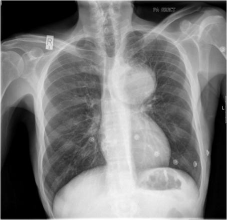Chest x-ray | Basicmedical Key