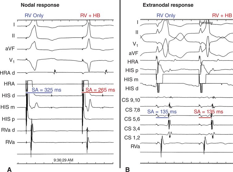 Diagnostic Maneuvers for Supraventricular Tachycardia: PVC on His and ...