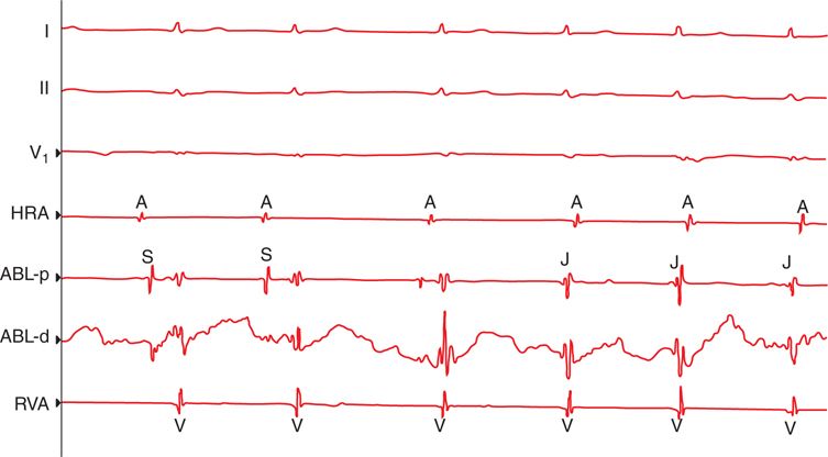 Typical Atrioventricular Nodal Reentrant Tachycardia | Basicmedical Key