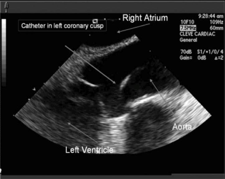 Ventricular Tachycardia and Cardiac Anatomy: Aortic Cusp | Basicmedical Key