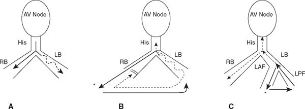 Diagnostic Maneuvers for Supraventricular Tachycardia: PVC on His and ...