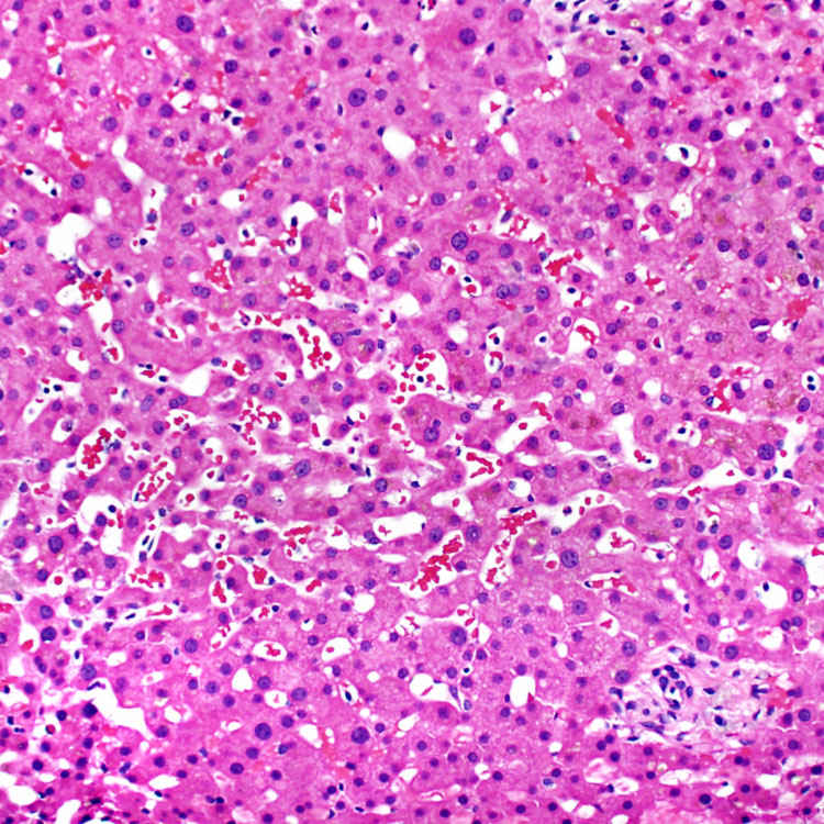 Hepatic Venous Outflow Obstruction | Basicmedical Key
