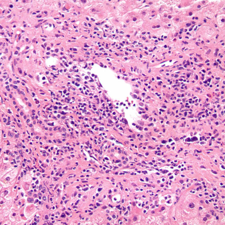 Acute Cellular Rejection | Basicmedical Key