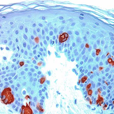 Toker Cell Hyperplasia | Basicmedical Key