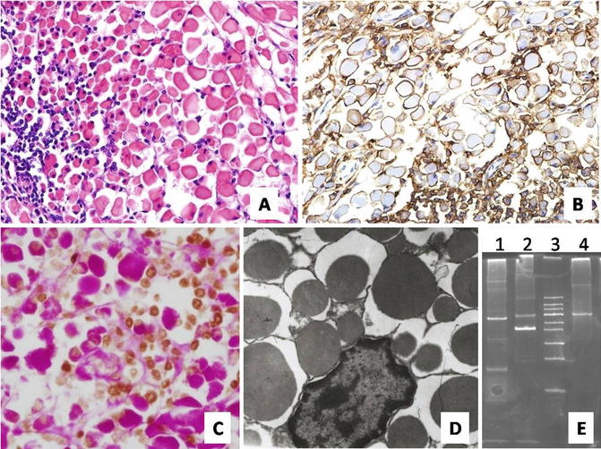 Pathologies of Renal and Systemic Intracellular Paraprotein Storage ...