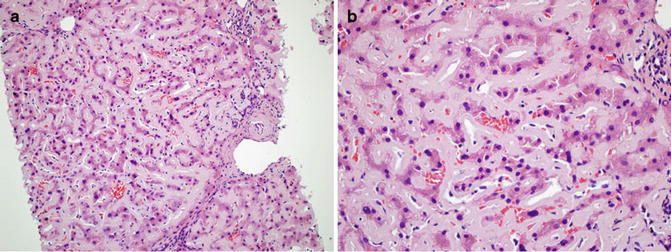 Amyloidosis of the Gastrointestinal Tract and Liver | Basicmedical Key