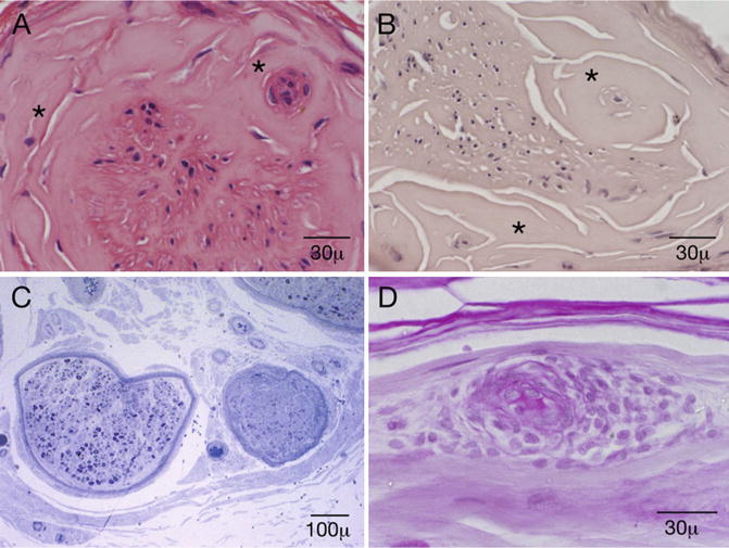 Peripheral Nerve Amyloidosis | Basicmedical Key
