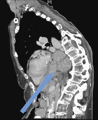 Fundoplication | Basicmedical Key