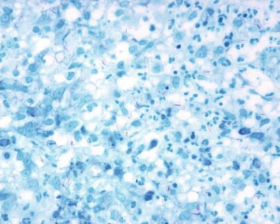 Differential Diagnosis: Intestinal Tuberculosis | Basicmedical Key