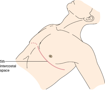 Thoracic Trauma | Basicmedical Key