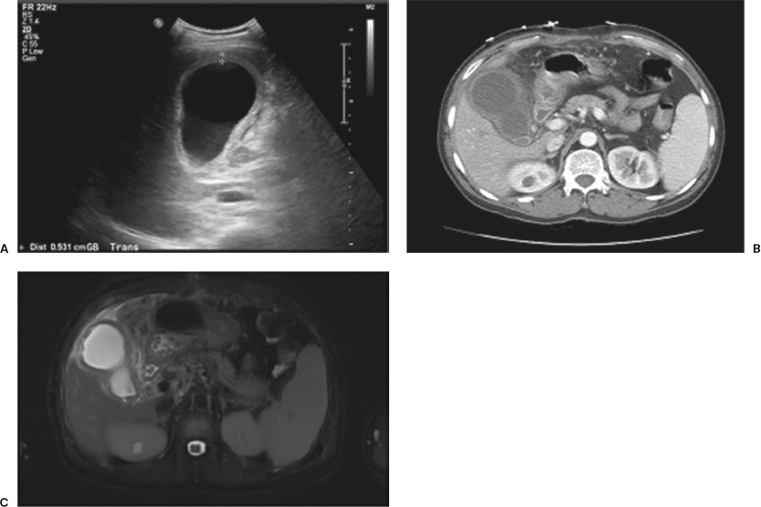 Calculous Biliary Disease | Basicmedical Key