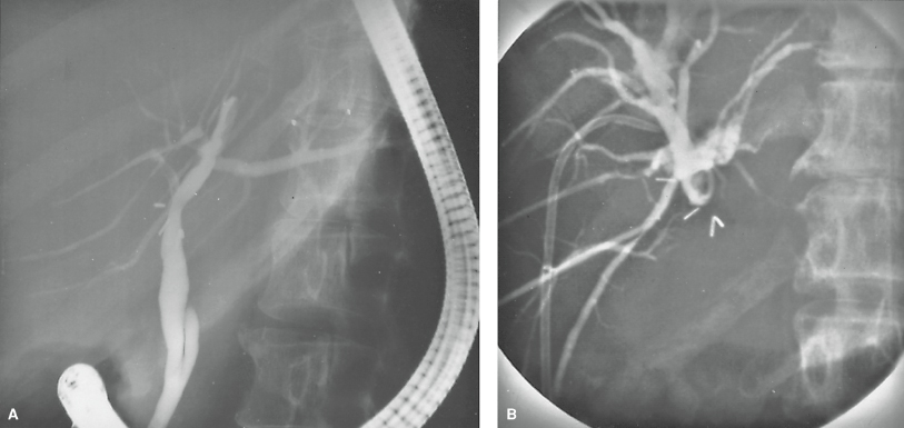 Biliary Injuries and Strictures and Sclerosing Cholangitis ...