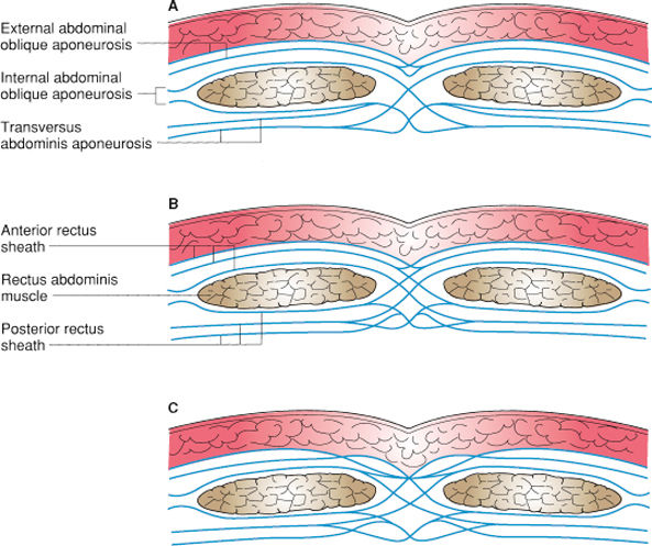 Abdominal Wall Hernias | Basicmedical Key