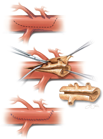 Renal and Splanchnic Vascular Disease | Basicmedical Key
