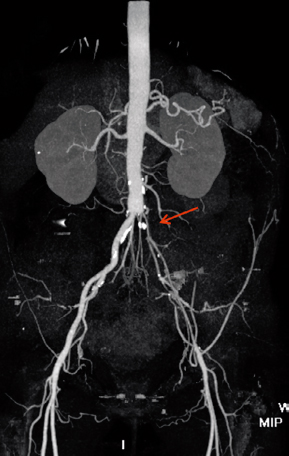 Aortoiliac Disease | Basicmedical Key