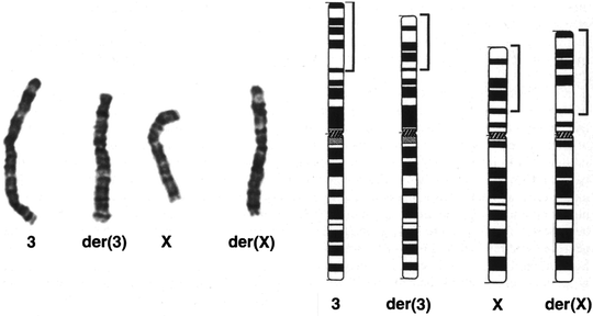 Sex Chromosomes Sex Chromosome Disorders And Disorders Of Sex