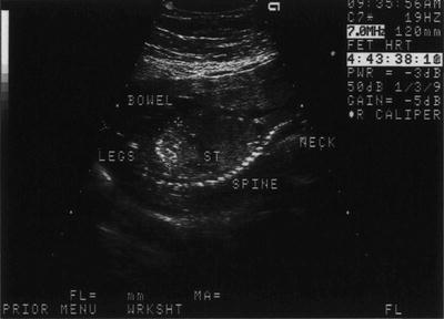 Prenatal Cytogenetics | Basicmedical Key