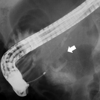 Endoscopy: ERCP and EUS | Basicmedical Key