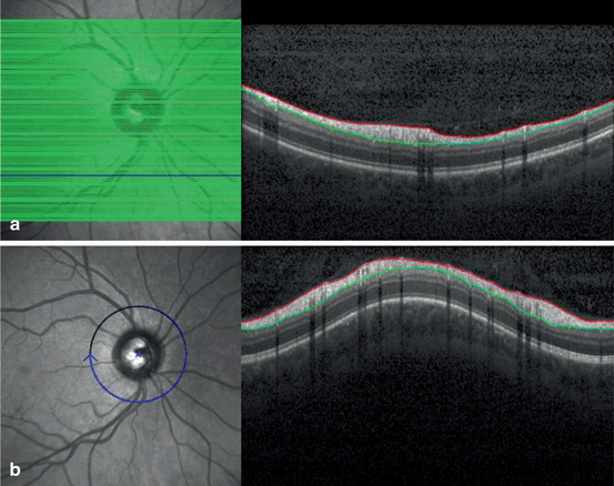 of the Retinal Nerve Fiber Layer Texture Related to the Thickness ...