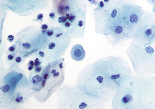 Non-Neoplastic Findings | Basicmedical Key