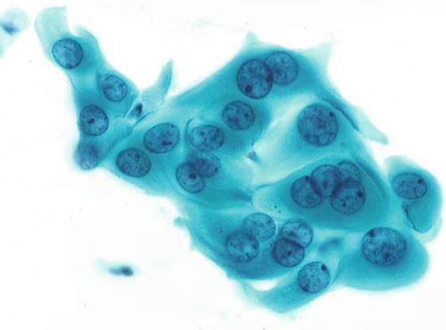 Non-Neoplastic Findings | Basicmedical Key