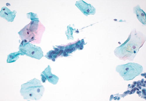 Non-Neoplastic Findings | Basicmedical Key