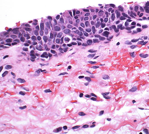 Non-Neoplastic Findings | Basicmedical Key