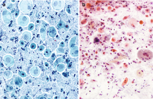 Non-Neoplastic Findings | Basicmedical Key