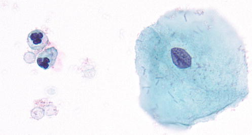 Non-Neoplastic Findings | Basicmedical Key