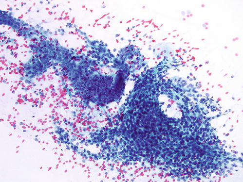 Non-Neoplastic Findings | Basicmedical Key