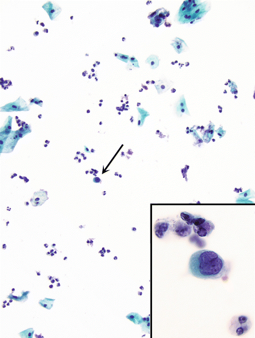 Epithelial Cell Abnormalities: Squamous | Basicmedical Key