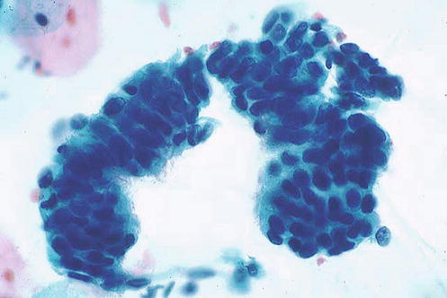 Epithelial Abnormalities: Glandular | Basicmedical Key