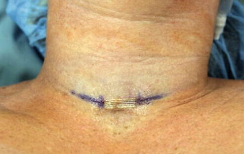 Minimally Invasive Non-endoscopic Parathyroidectomy | Basicmedical Key