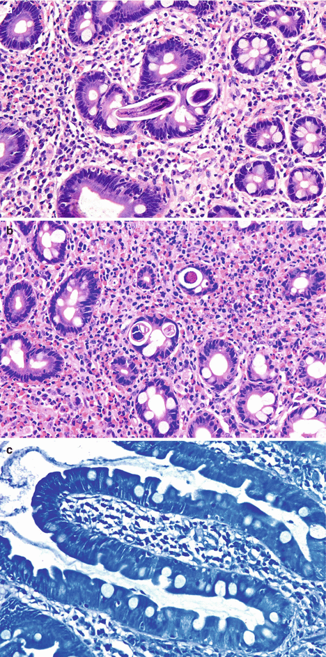 Multiple Opportunistic Infections | Basicmedical Key