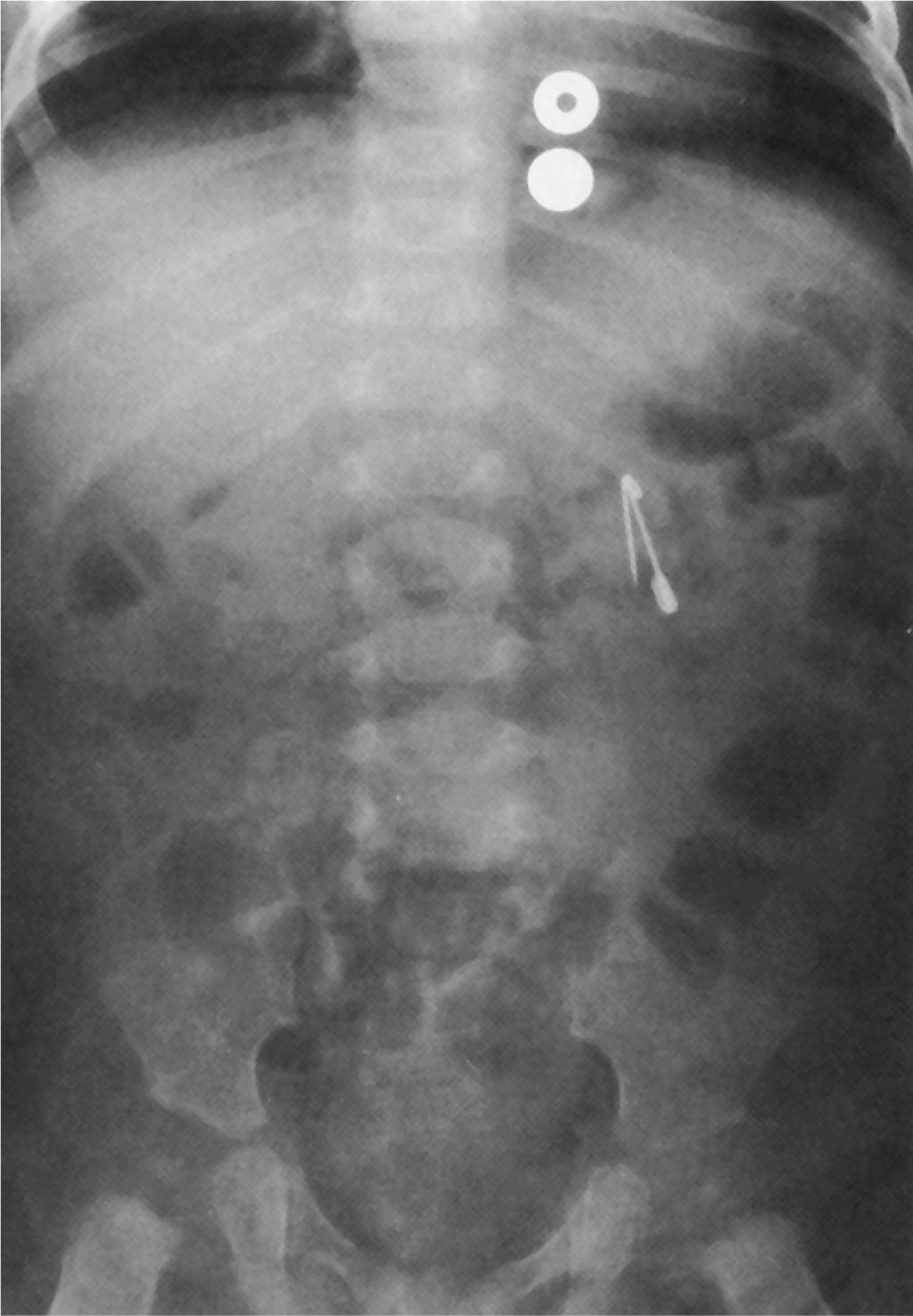 Pediatric Surgery: Surgical Diseases Of Children | Basicmedical Key