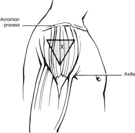 Deltoid Muscle Injection