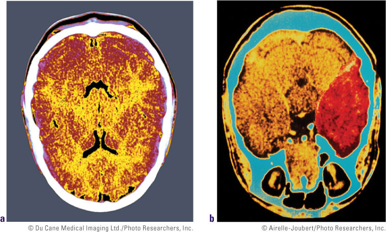 Rabies | Basicmedical Key