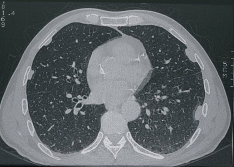 Pulmonary Medicine Board Review Questions | Basicmedical Key