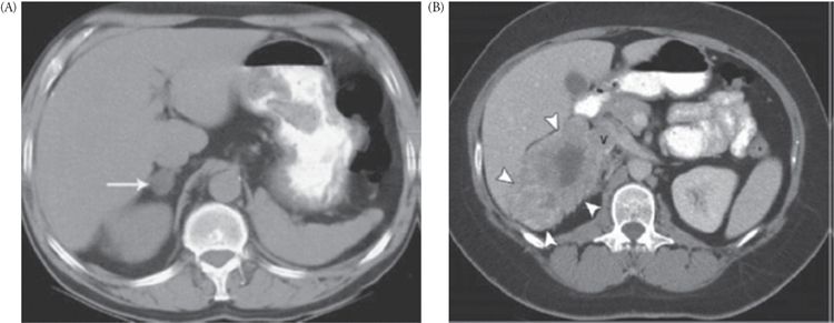 Adrenal Disorders | Basicmedical Key