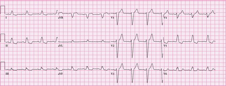 EKG Refresher | Basicmedical Key