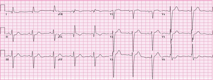 EKG Refresher | Basicmedical Key