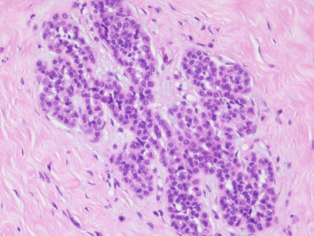Lobular Lesions (Lobular Neoplasia, Invasive Lobular Carcinoma ...