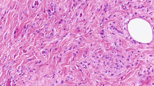 Spindle Cell Lesions | Basicmedical Key
