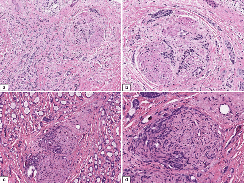 Invasive Carcinoma | Basicmedical Key