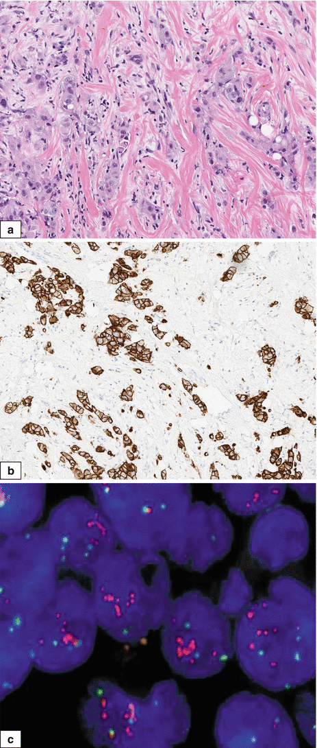 Invasive Carcinoma | Basicmedical Key